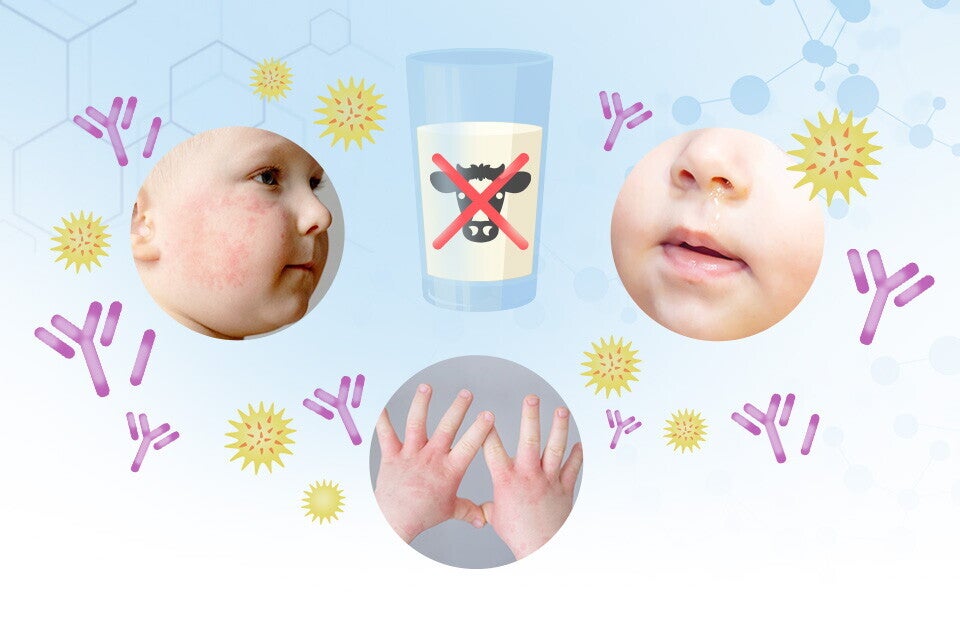 Unraveling Cow's Milk Protein Allergy (CMPA) in Infants and Young Children